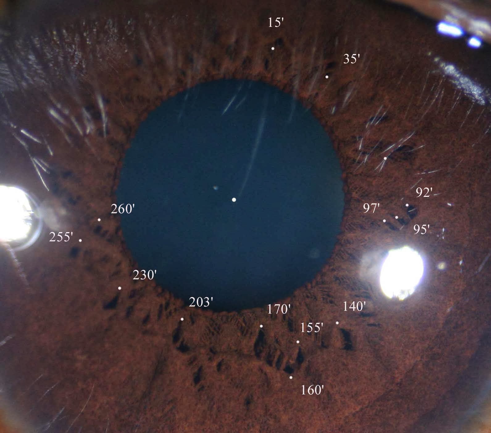 Modern & Multidimensional Iridology: Multiple Crypts Formation at ...