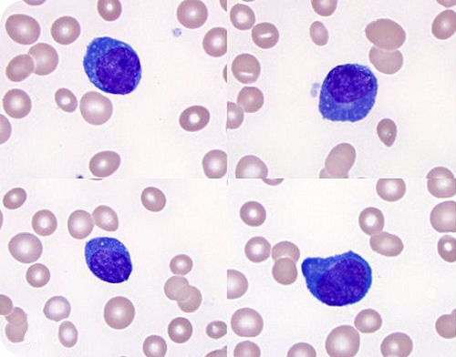 Medical Laboratory and Biomedical Science: Circulating reactive plasma ...