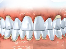 Dra. Dianita: Enfermedad Periodontal