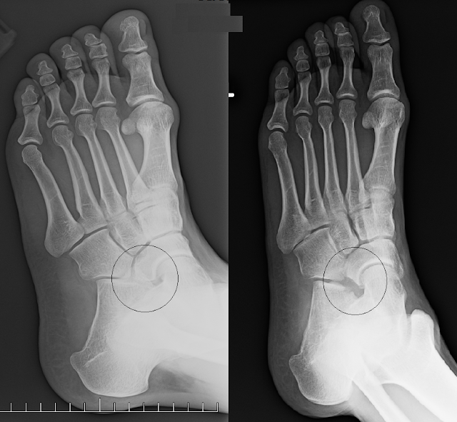 Tarsal Coalition: Tarsal Resection Before and After X rays