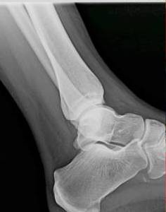 Os Peroneum Fracture-Plain Film - Sumer's Radiology Blog