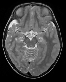 Rasmussen’s encephalitis-MRI - Sumer's Radiology Blog