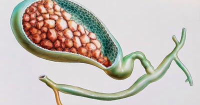 Tradisjonskost: Gallestein