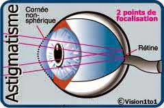 Apa Pengertian Astigmatisme Itu? | i Health