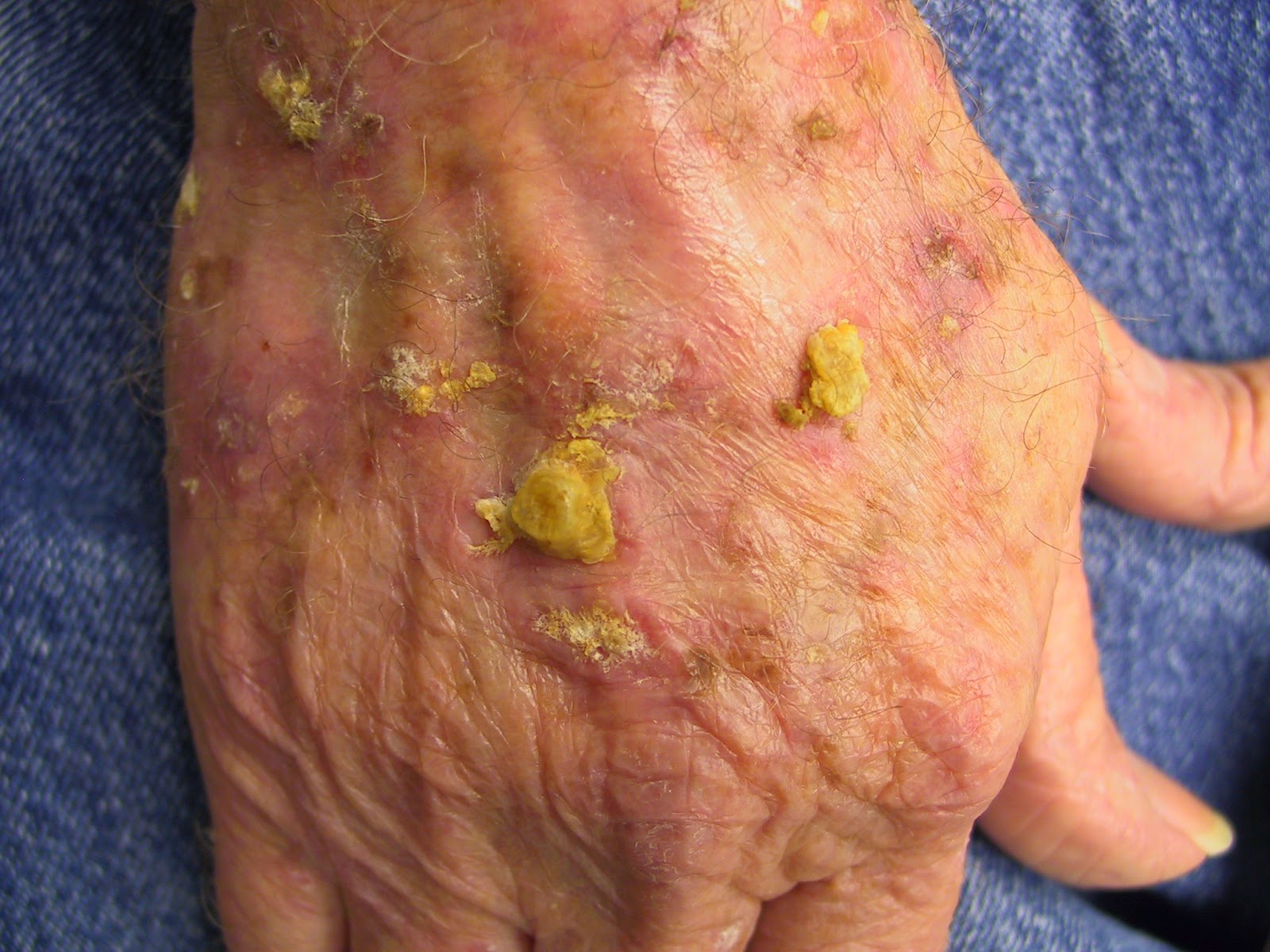 SKIN DISEASE TYPES: Actinic Keratoses