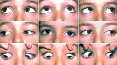 Eye 2 Eye Optometrists: Vertical Strabismus ----- Definition,Types ...