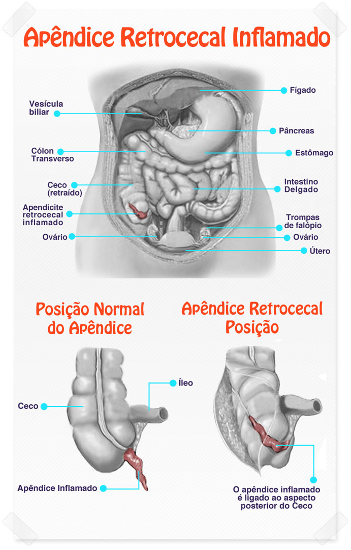 Dicas de Enfermagem: Apendicite