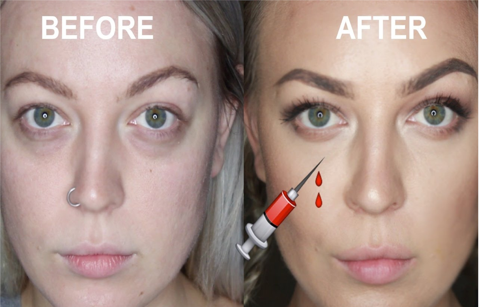 Tear Troughs - Replace The Lost Volume With Dermal Fillers