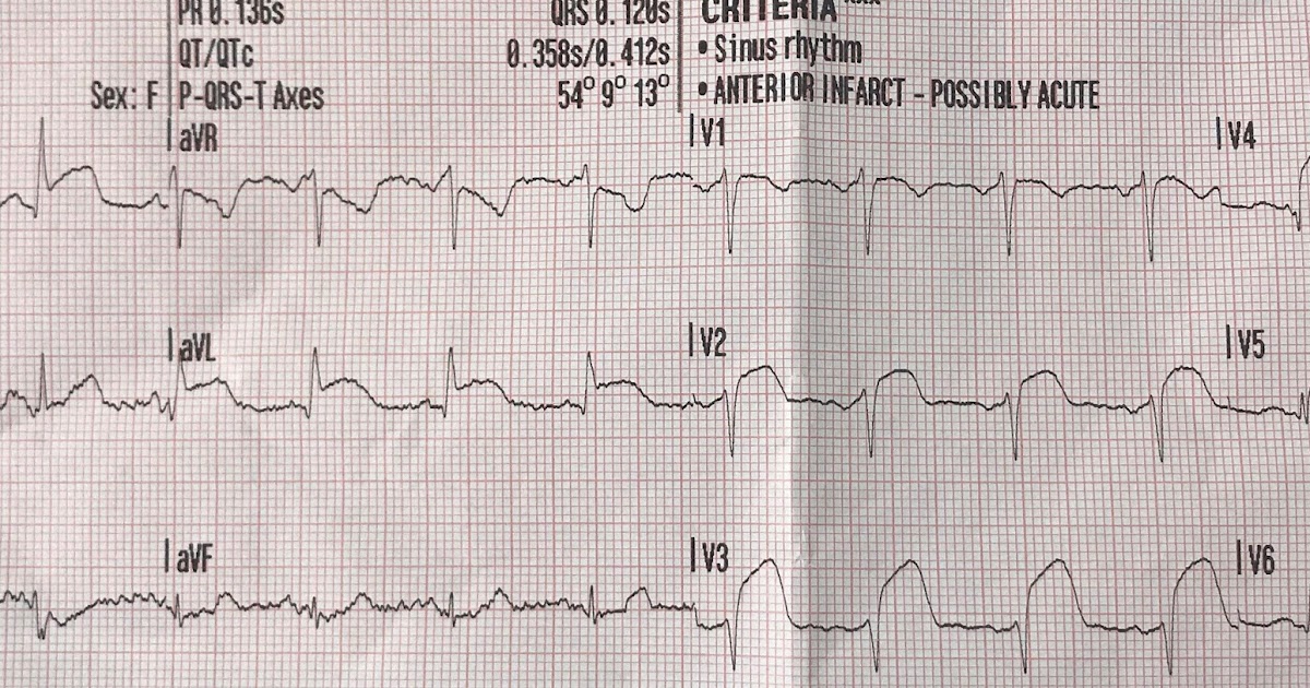 Dr. Smith's ECG Blog: 15 hours of chest pain. Too late for ...
