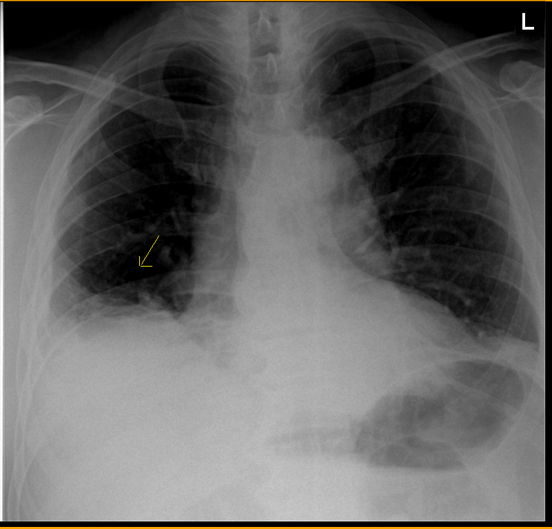 Possible Pulmonary Embolism-Plain Film - Sumer's Radiology Blog