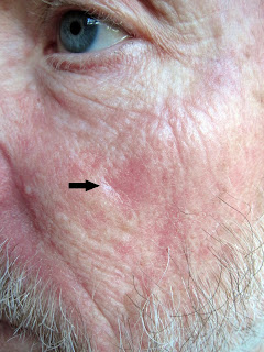 Efudex - Round Two: Day 24 (Recovery Day 10)