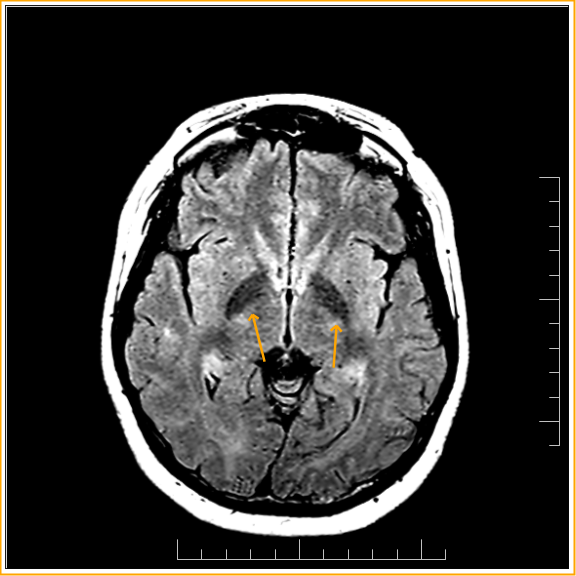 Mitochondrial protein-associated neurodegeneration (MPAN): MRI - Sumer ...
