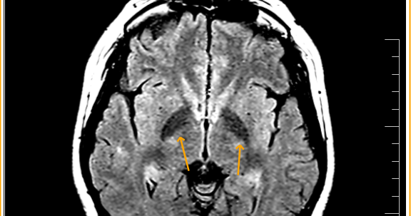 Mitochondrial protein-associated neurodegeneration (MPAN): MRI - Sumer ...