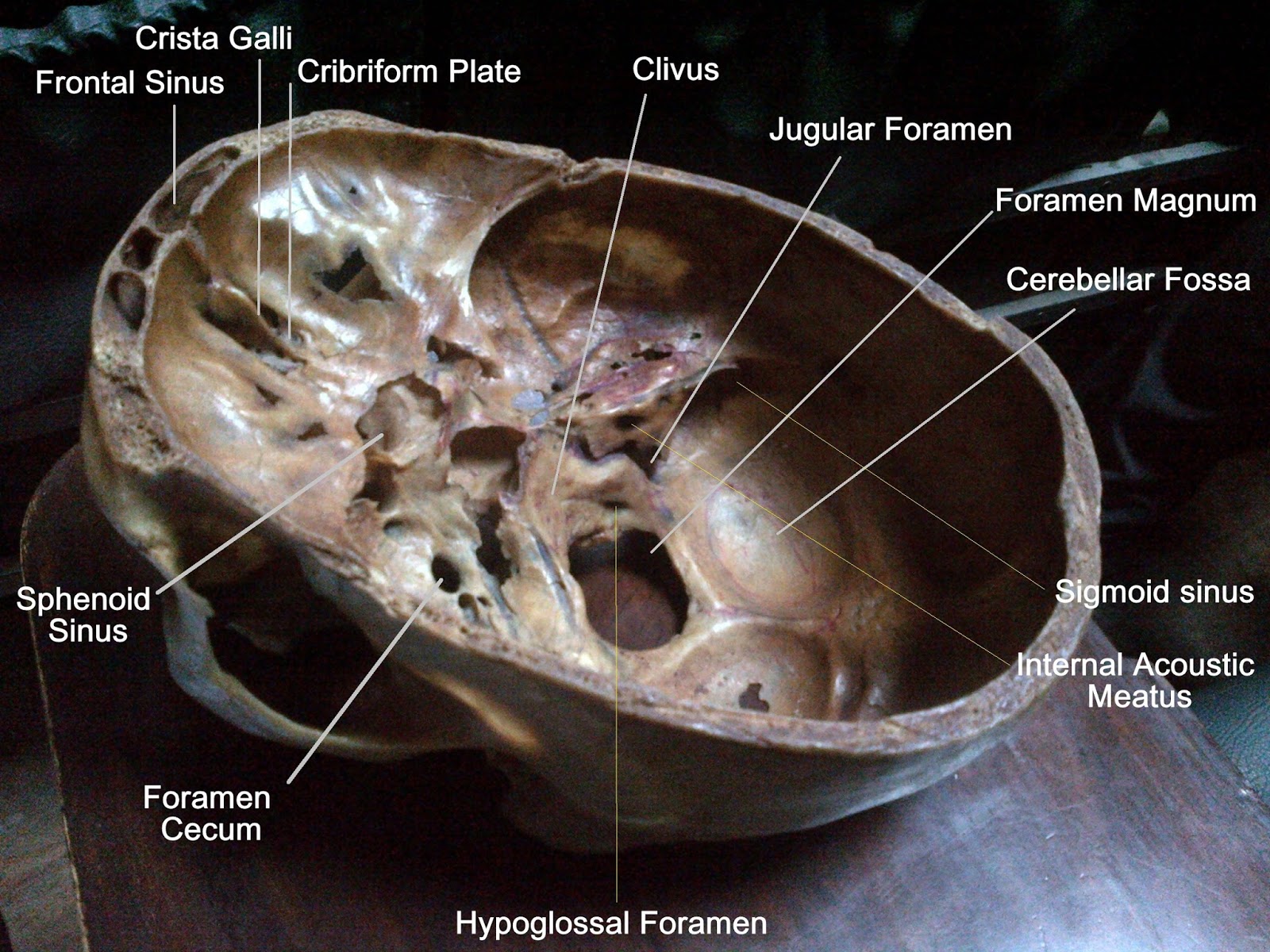 Anatomy Made Easy Base Of The Skull Anatomy Made Easy Base Of The Skull