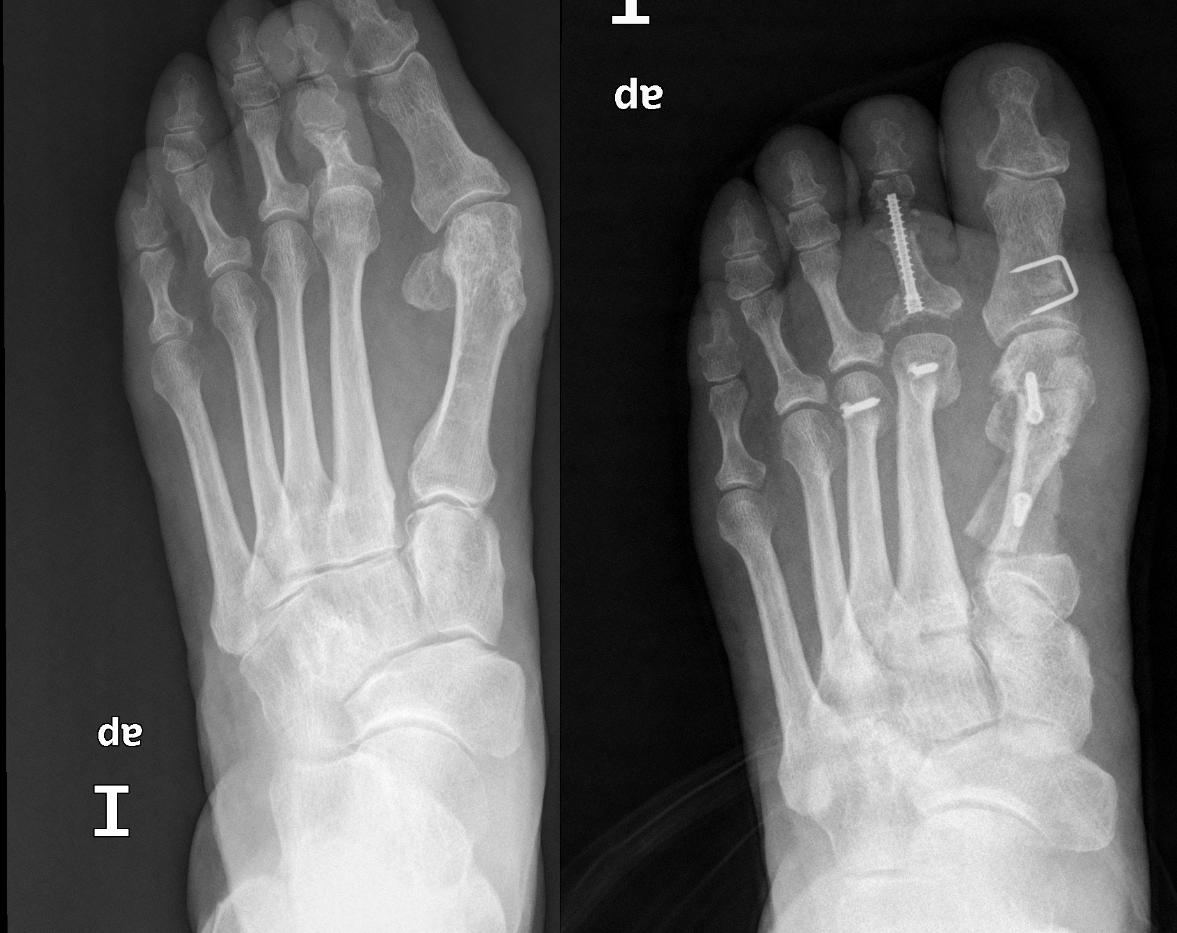 Fanáticos del pie: RECIDIVA HALLUX VALGUS Y LESION PLACA PLANTAR