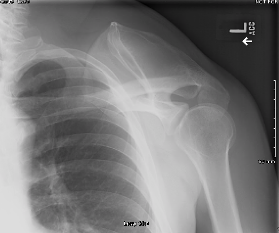 Shoulder and Elbow Surgery: Locked scapula syndrome (or scapular ...