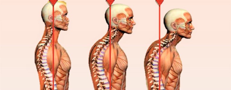 RECUPERACION FUNCIONAL DE LA CIFOSIS POR MEDIO DEL MASAJE PROFUNDO
