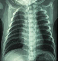 Health Information Today: Respiratory Distress Syndrome (RDS)