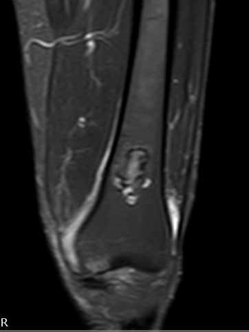 Enchondroma-MRI - Sumer's Radiology Blog
