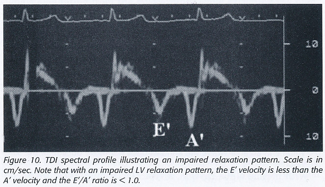 Pedi cardiology: Tissue Doppler Imaging - Mitral Lateral Annulus TDI