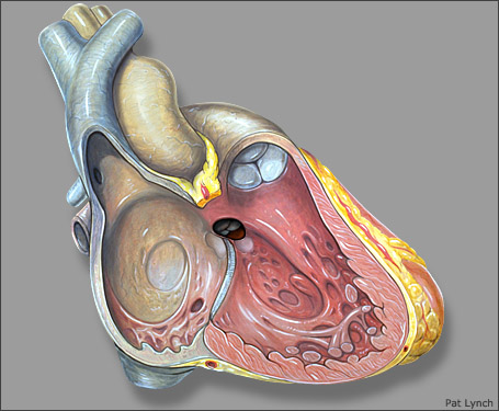 Phimaimedicine: 1,260. Small perimembranous ventricular septal defect ...