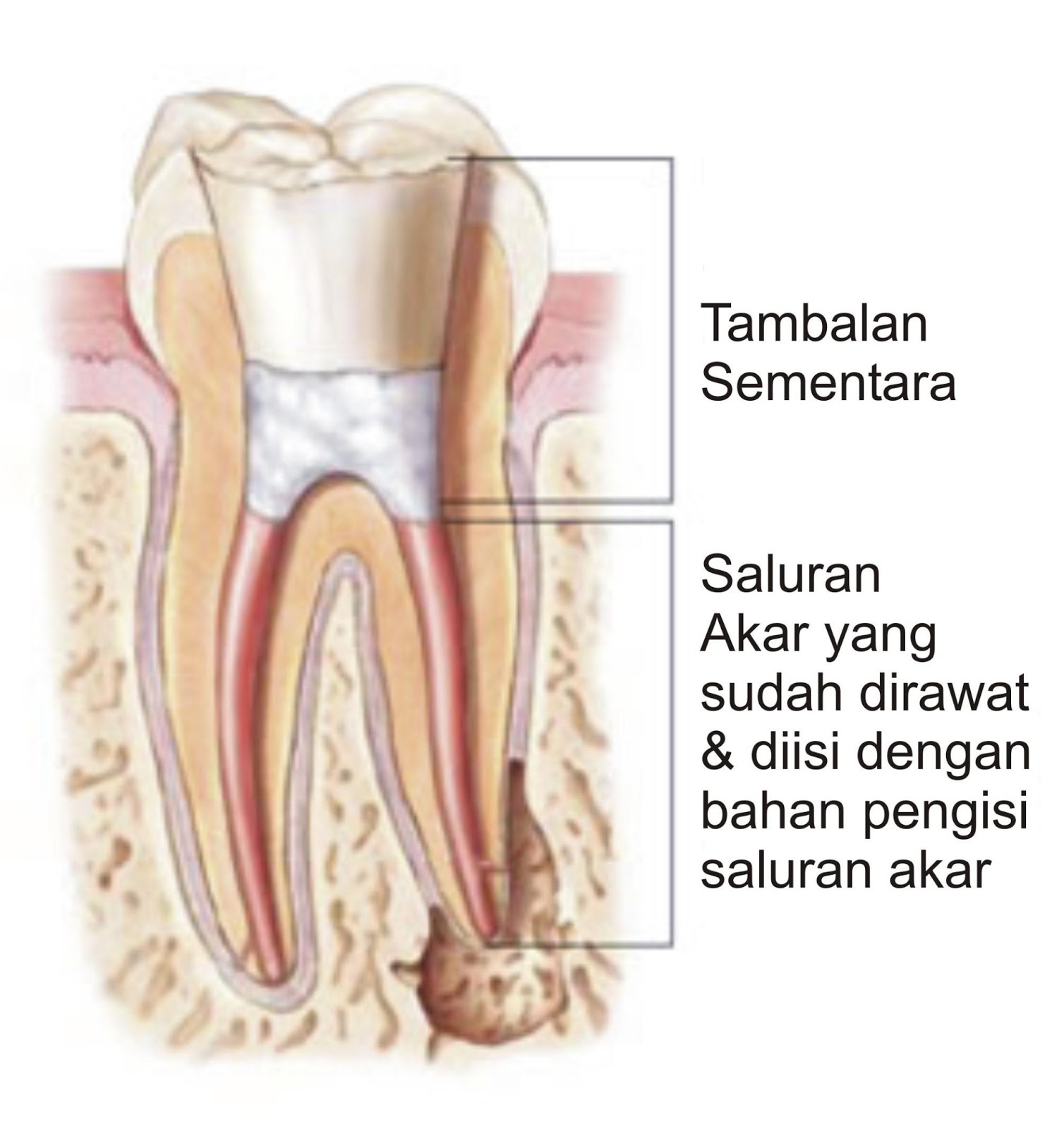 Perawatan Saluran Akar Gigi untuk Menambal Gigi Berlubang | Floem
