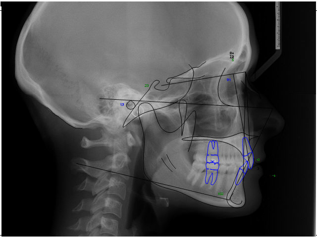 Surrideo Orthodontics - Damon Braces - Invisalign - Incognito: What are ...