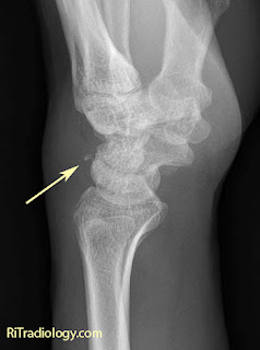 RiT radiology: Triquetral Fracture