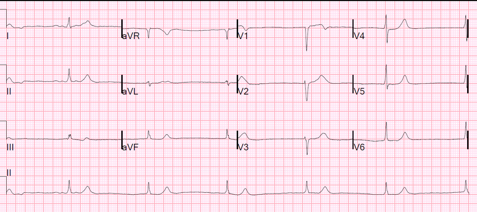 Dr. Smith's ECG Blog: Weakness and Hypotension, with Bradycardia.