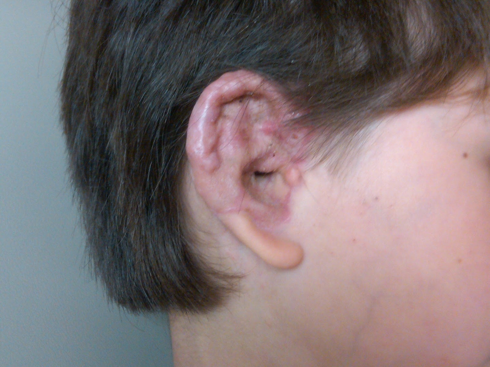 Microtia and Aural Atresia - Our Experience: Three and a Half + Post ...