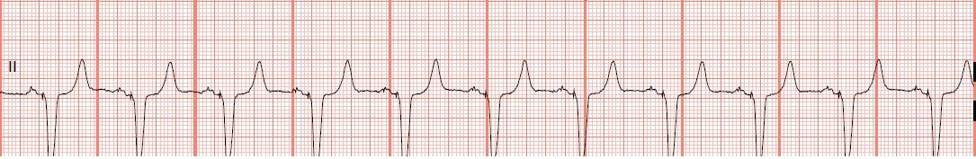 Practice EKG Rhythm Strips 127
