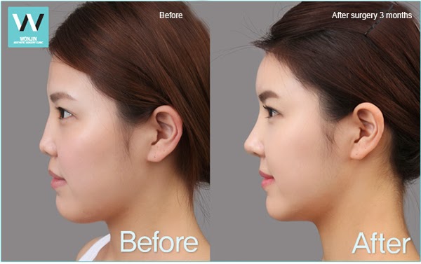 Short nose correction plastic surgery in Korea