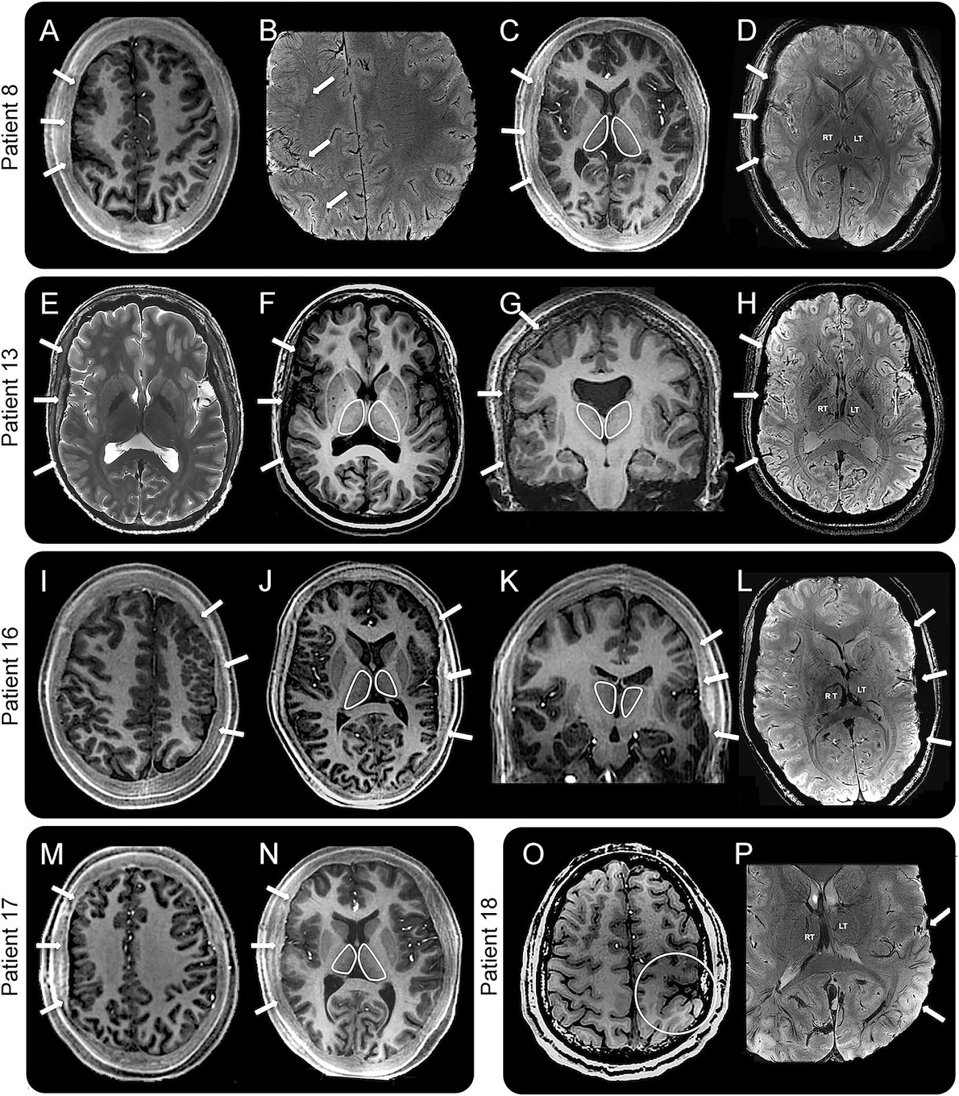 pediatric neurology: Polymicrogyria, thalamic hypoplasia and epilepsy ...