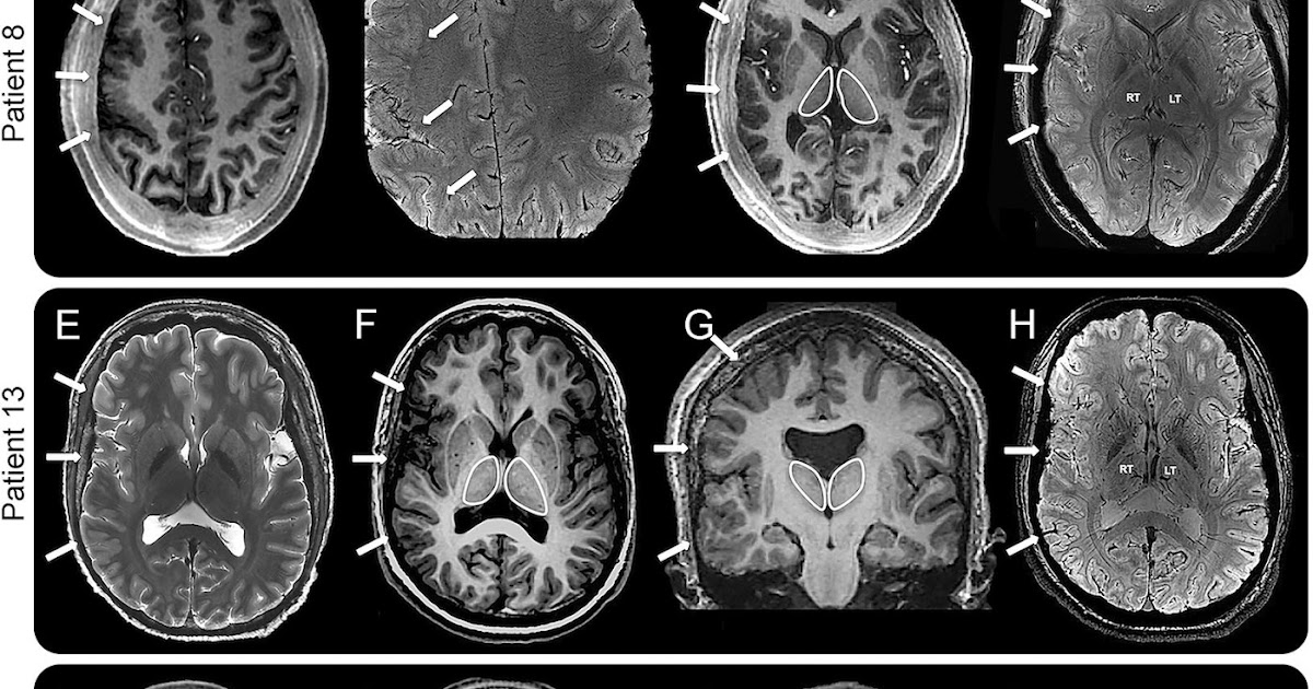 pediatric neurology: Polymicrogyria, thalamic hypoplasia and epilepsy ...