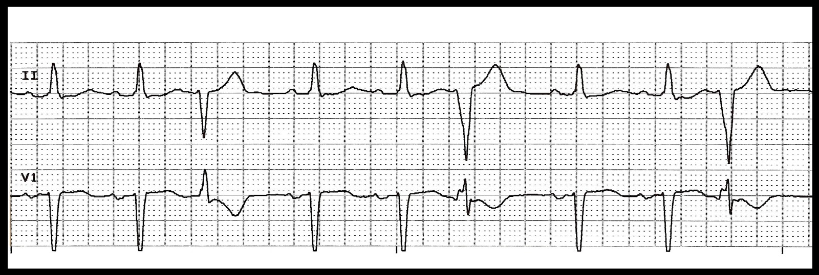 Basic EKG Rhythm Test 34