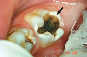 Odontologia Recife: CÁRIE AGUDA E CÁRIE CRÔNICA