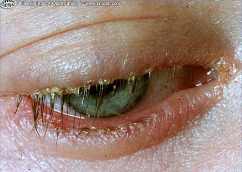 Science Behind the Scenes: Eye Infections