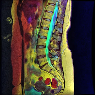 Nevit's blog: Color MRI of the Lumbar vertebrae