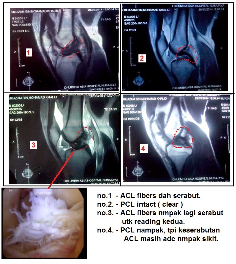 PART 2 - kecederaan Lutut ( Signs of a TORN ACL )