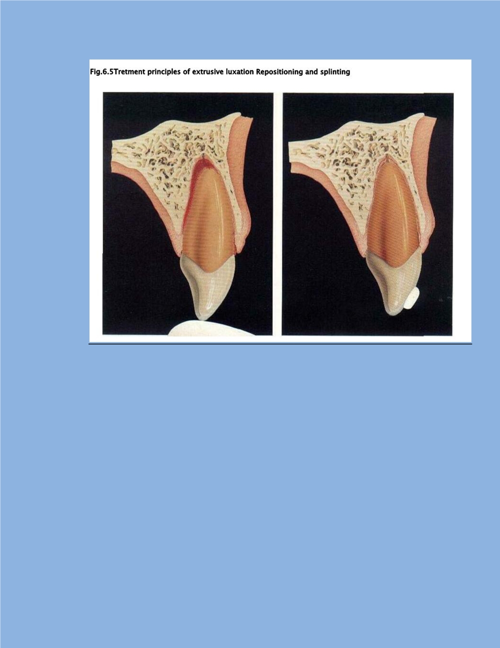 DOs and DONTs in DENTISTRY: CONCUSSION ,SUBLUXATION,EXTRUSION ,LATERAL ...