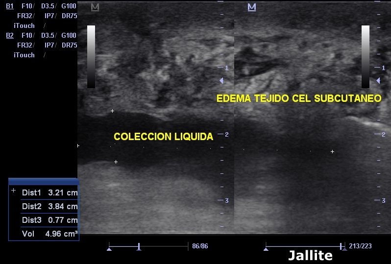 Edema Celular Sub-Cutaneo