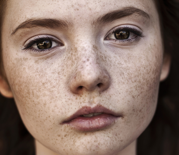 7 Hal Aneh yang Harus Anda Ketahui Tentang Freckles - Berita Ibu Kota