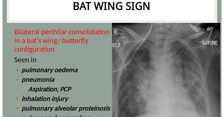 Chest Medicine Made Easy-Dr Deepu: Bat Wing Sign