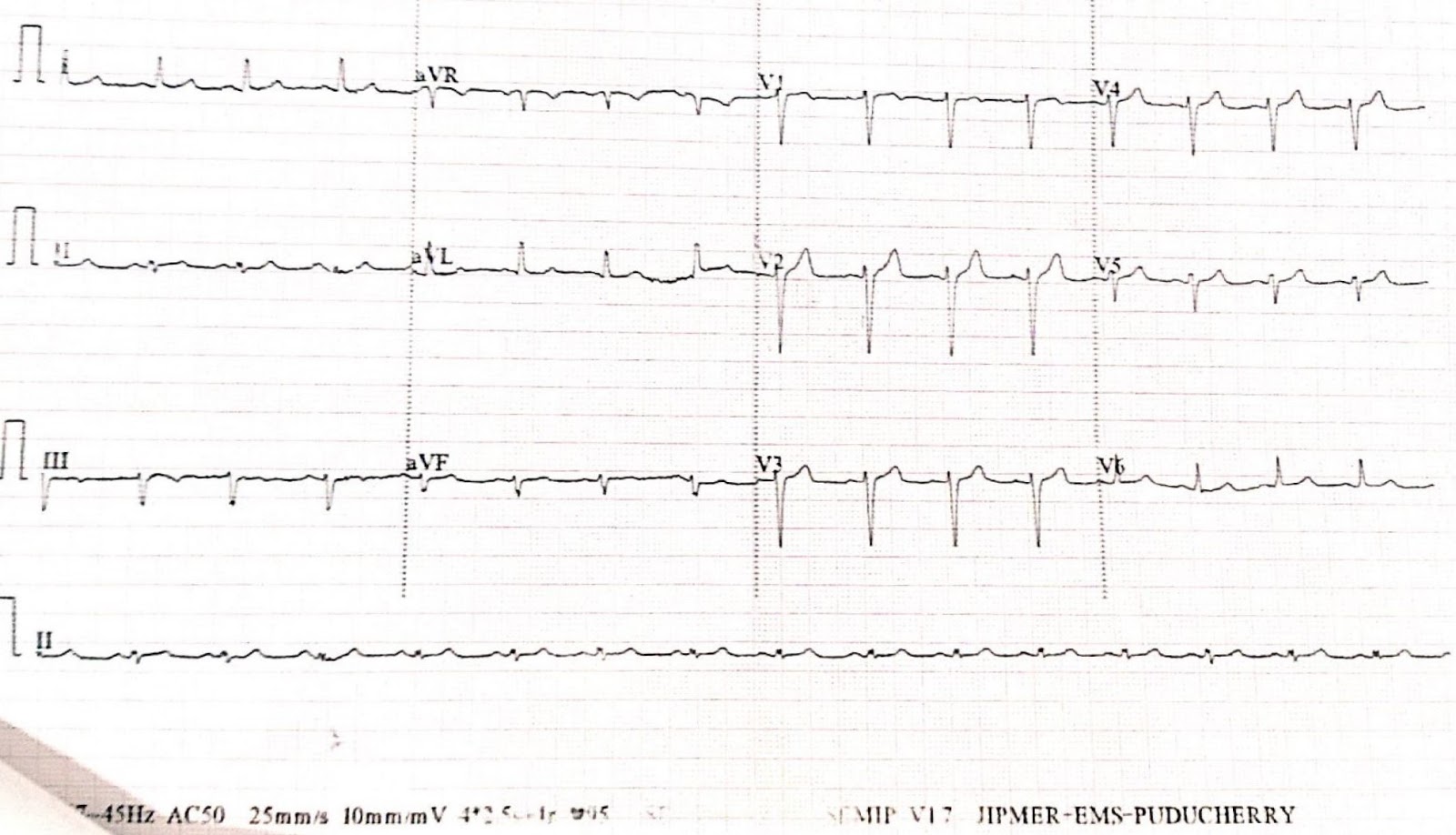 Cardiology window: ECG Mahaim fiber tachycardia