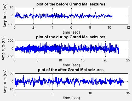 Biomedical Signal and Image Processing projects using Matlab and Labview tools: Matlab code to ...
