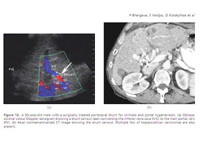 BÀI SOẠN VỀ SIÊU ÂM CHẨN ĐOÁN: Hepatic Vascular Shunts