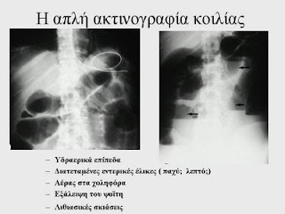 ΑΓΆΠΗ ΓΙΑ ΖΩH: ΟΞΕΙΑ ΚΟΙΛΙΑ