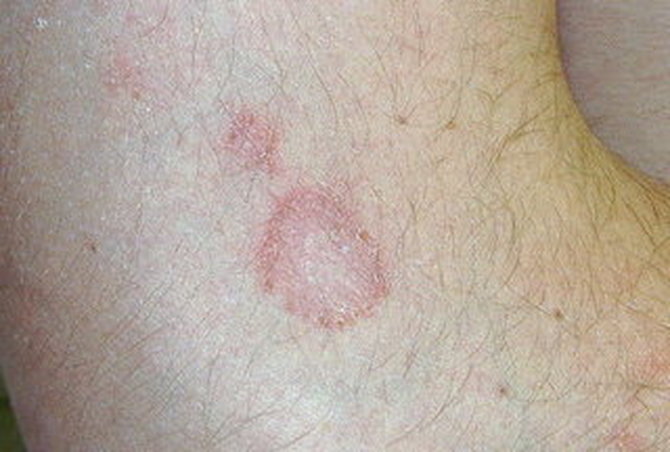 Borelioza - Barbara Plucinska - choroba z LYME: Choroby powodujące ...