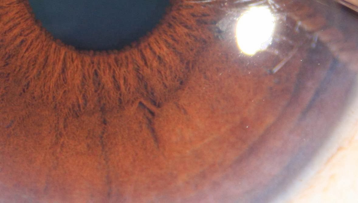 Modern & Multidimensional Iridology: The Collarette in Modern Iridology ...