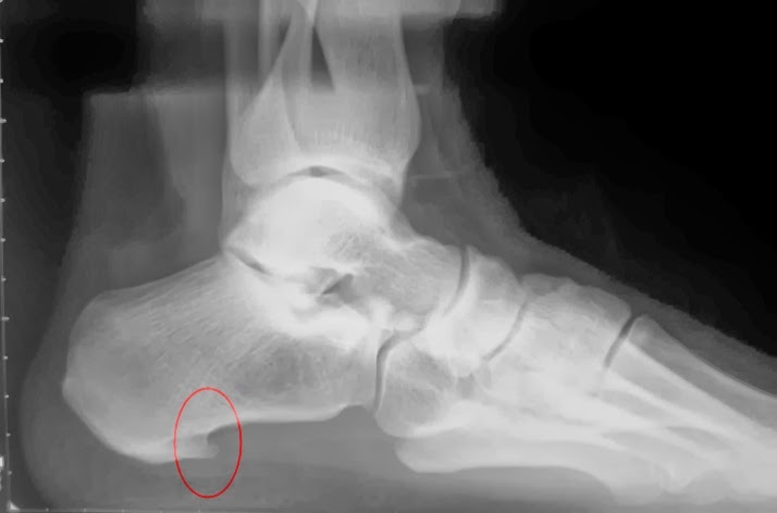 El verdadero Blog del verdadero Jokin: El espolón